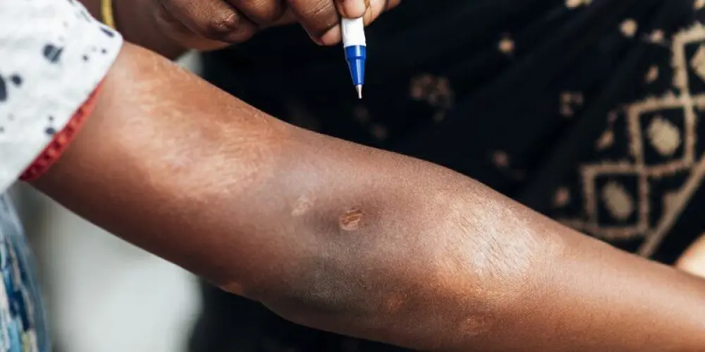 What can leprosy do to your body? - Leprosy Mission Australia